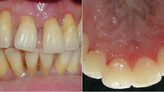 Dental News - Maintenance of periodontally compromised teeth with ...