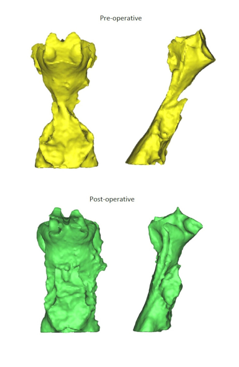 Dental News - Novel application of jaw advancement surgery helps treat ...