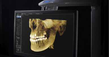 Carestream Dental introduces CS 9300-1