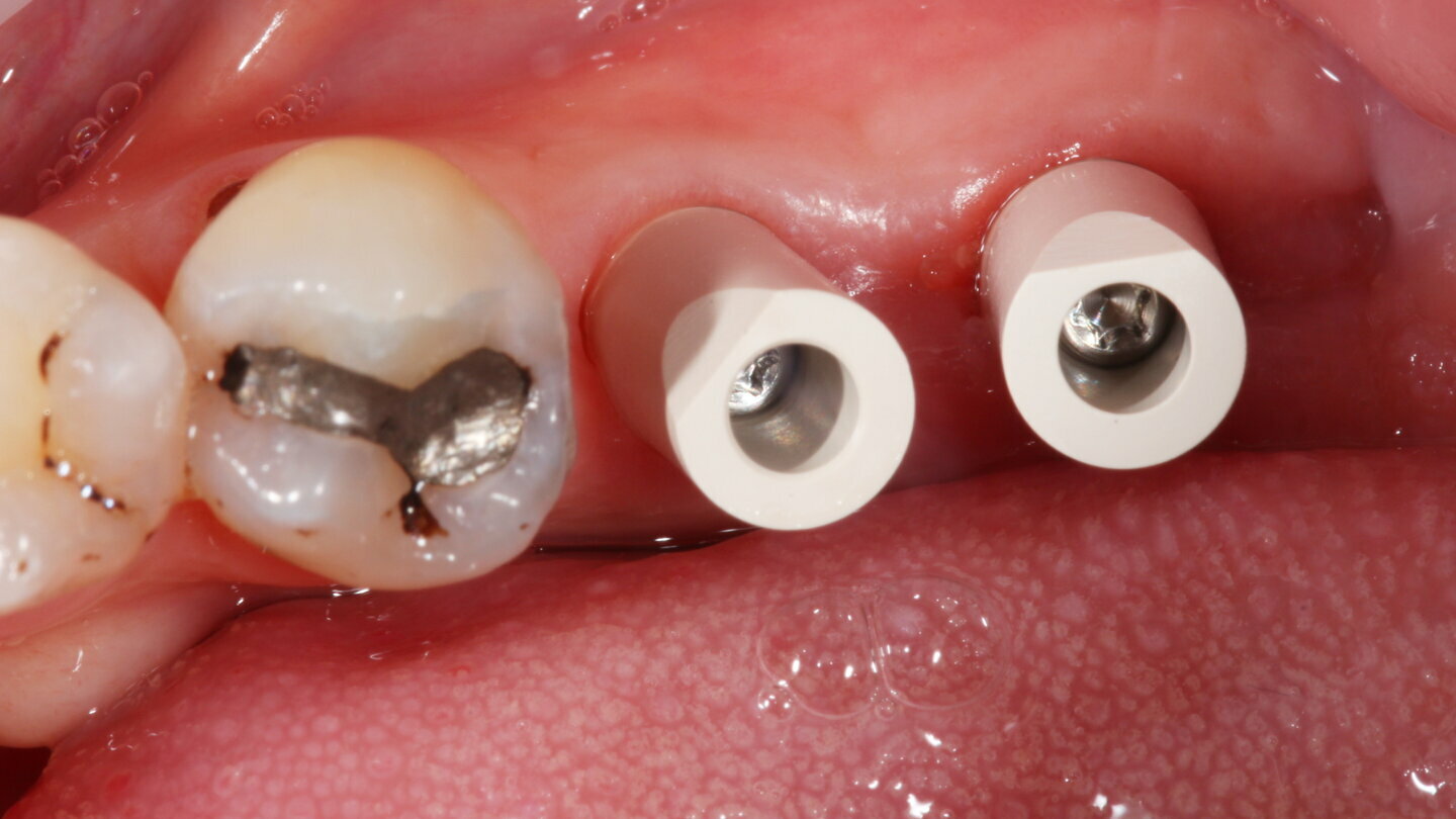 Dental News - Mastering the implant digital workflow