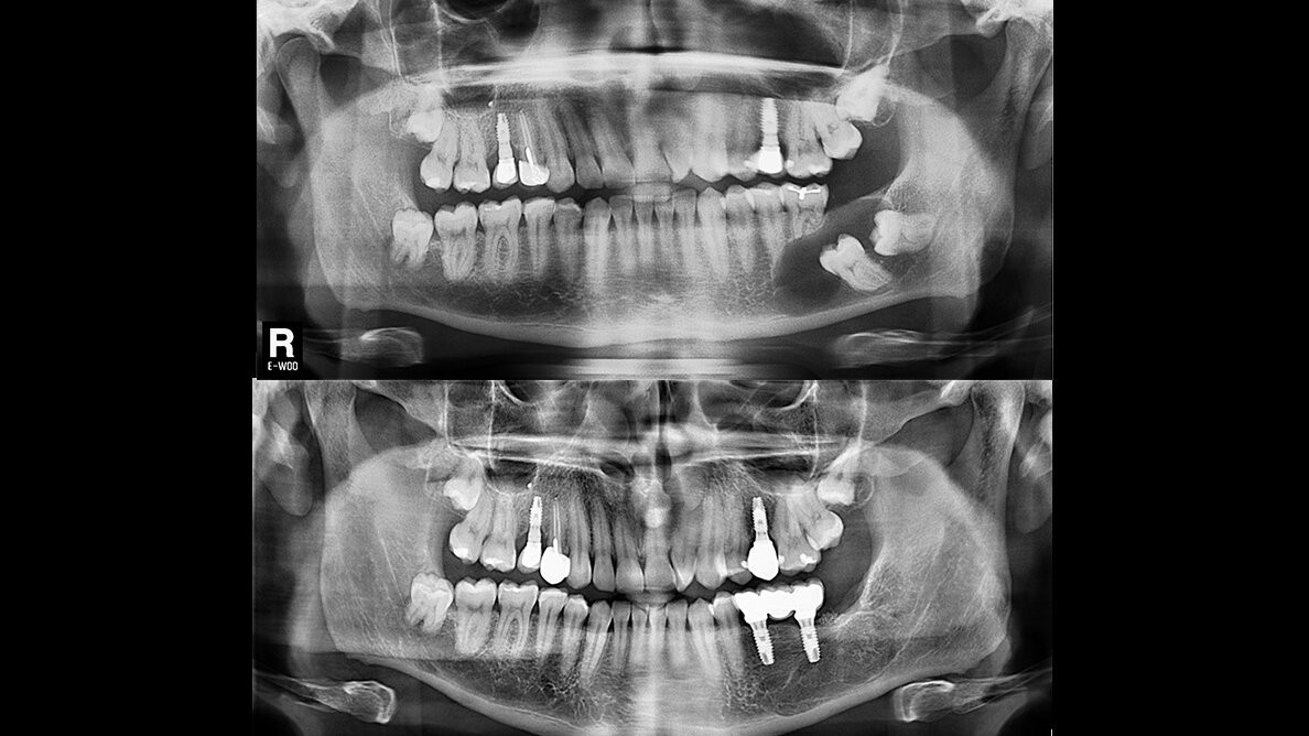 DT News - Latin America - Enucleación de quiste dentígero mandibular y ...