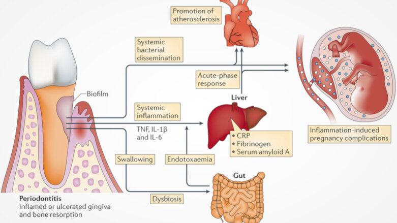 Periodontist webinar successful periodontitis treatment