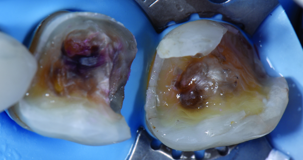 Simple layering technique with direct composite restorations