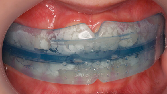 Dental News - Tooth positioning appliances: An orthodontist’s experience