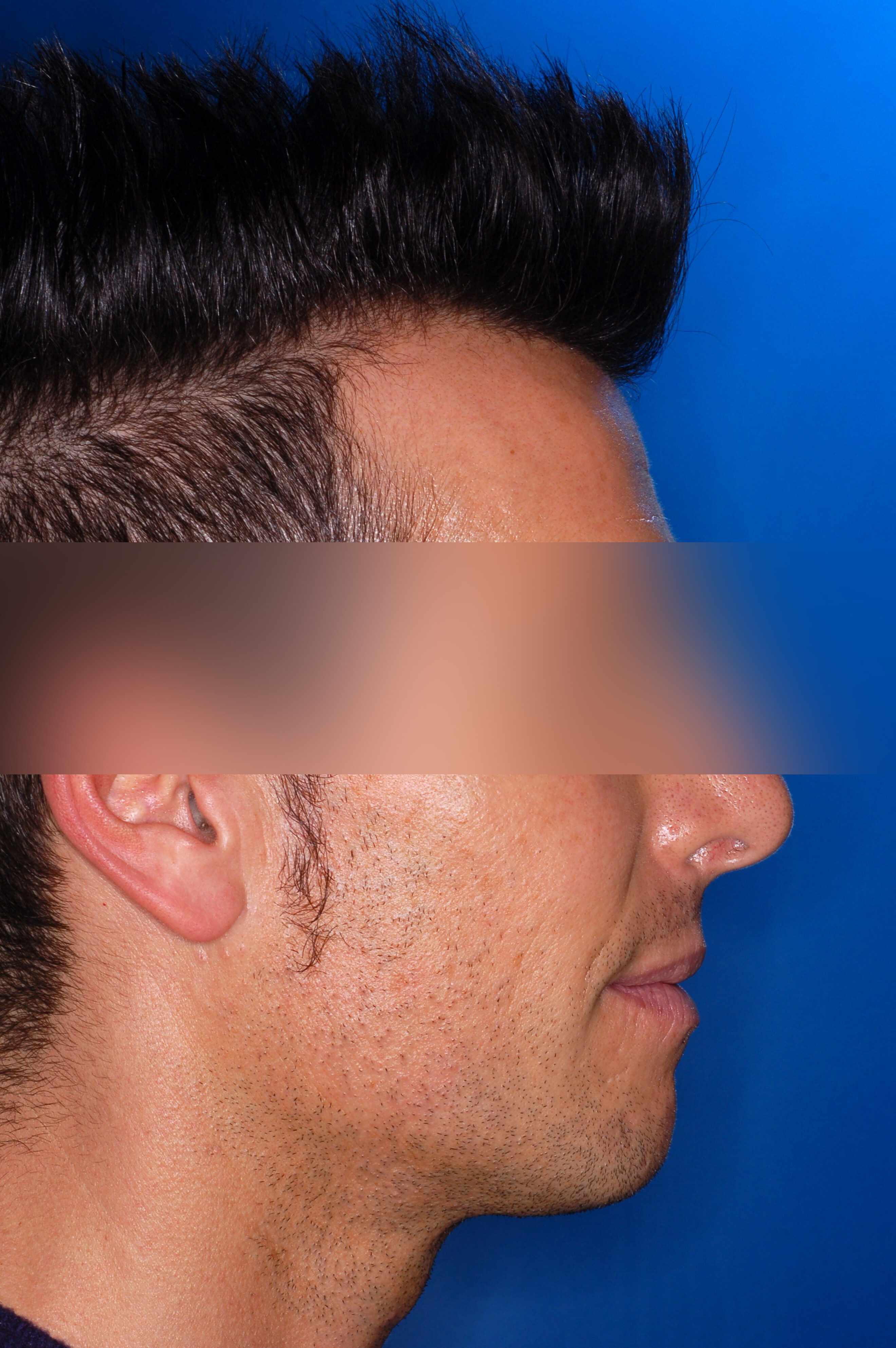 A Class II open bite case