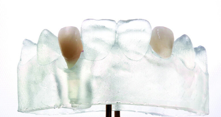 Dental News - Mastering the implant digital workflow