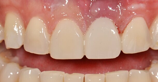 Bridge provisoire direct collé à la résine et élément de bridge ...