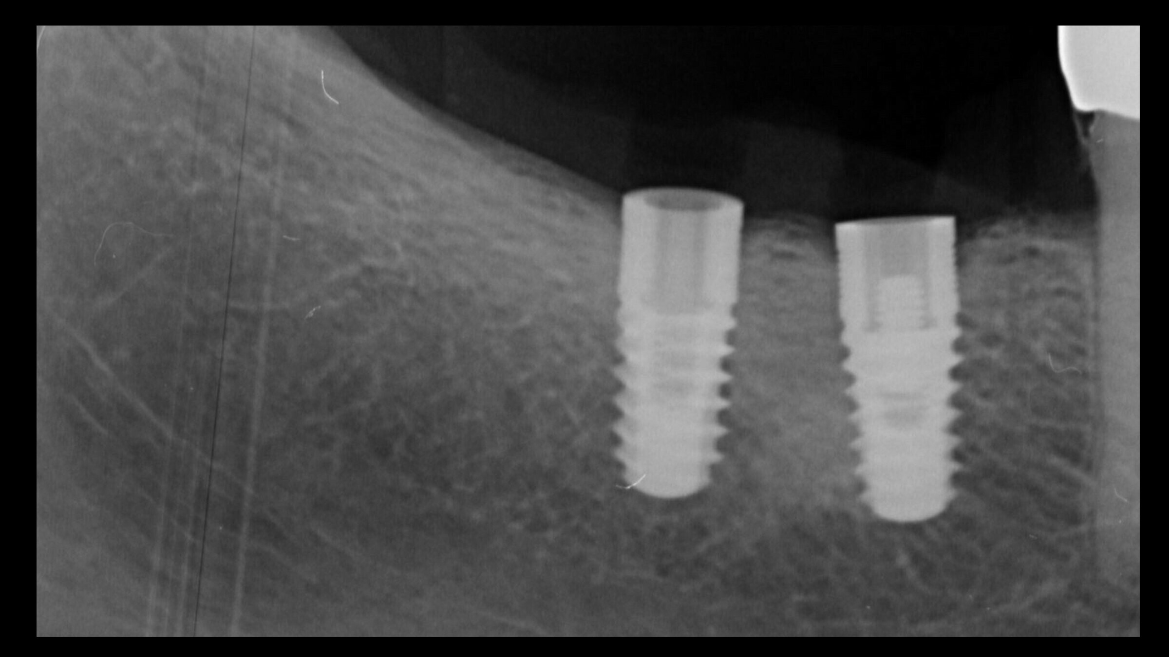 DT News - Latin America - Restauración protésica sobre implantes ...
