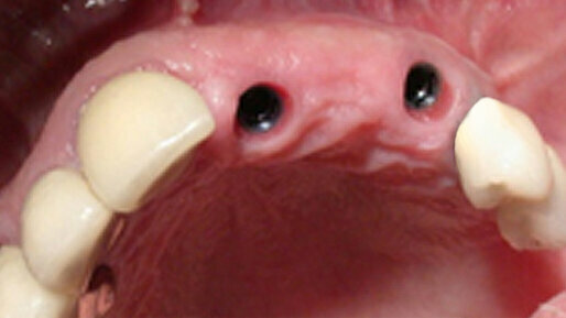 Dental News - Screw-retained, implant-supported fix partial denture (FPD)