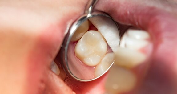 Glass hybrid technology: An alternative to dental amalgam
