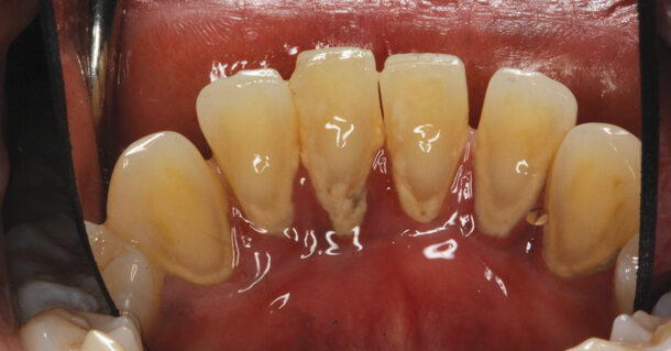 Dental News - Systemic and dental factors affecting the prognosis of teeth