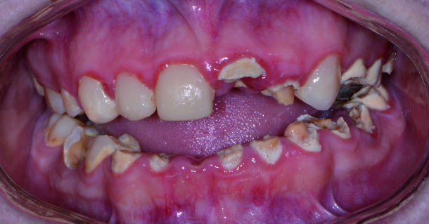 DT News - International - Replacing a failing dentition with new technology