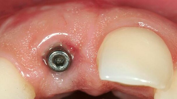 Replacement of a single anterior tooth: Surgical procedure and three ...