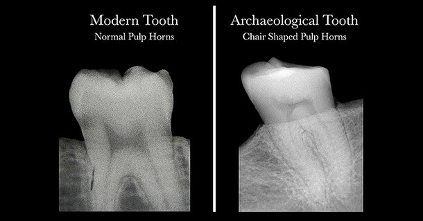 DT News - International - Scientists discover that dental radiographs ...