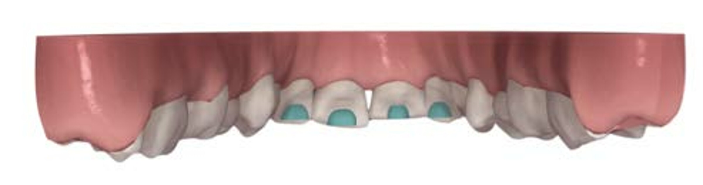 Proper curve of Spee levelling