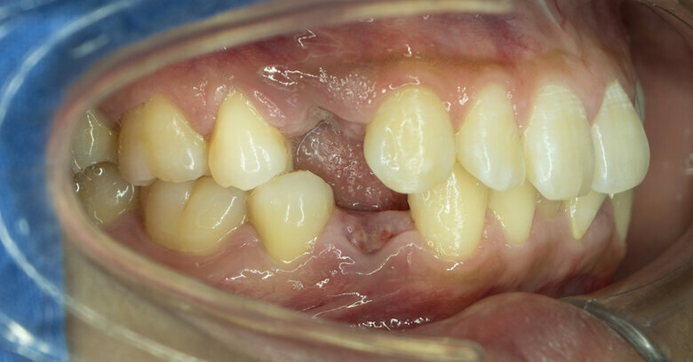 Dental News - What to consider when caring for partially dentate patients