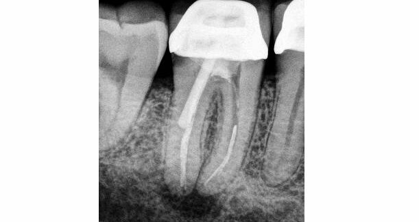 Endodontic success: It’s all about the apical third