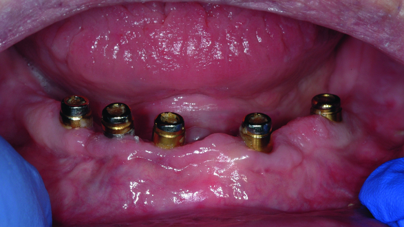 Treatment options for the edentulous arch