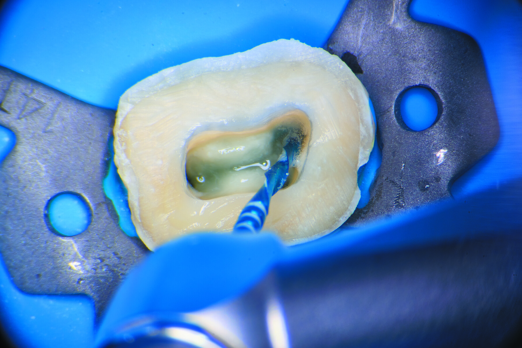 New approach to root canal preparation: The in–out technique
