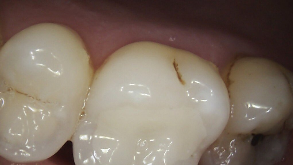 DT News - MEA - Removal of leaking amalgam restorations and placement ...
