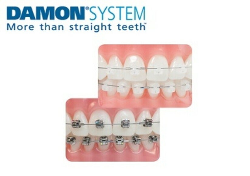 Ormco Damon System