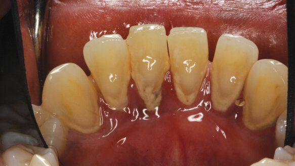 Systemic and dental factors affecting the prognosis of teeth