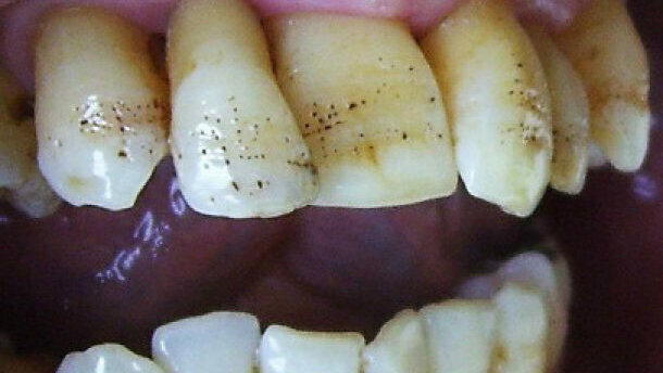 Dental News - Er:YAG laser conditioning of hypoplastic enamel