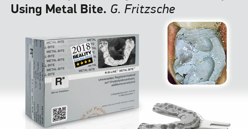 Efficient Dynamic Registration Technique Using Metal Bite.