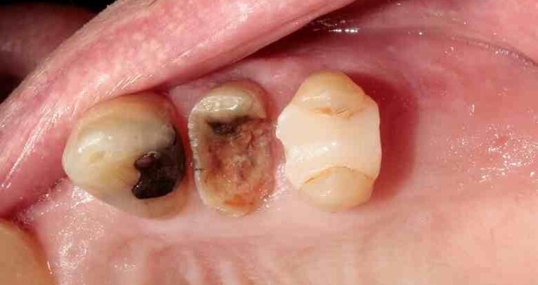 Dental News - Managing maxillary molars