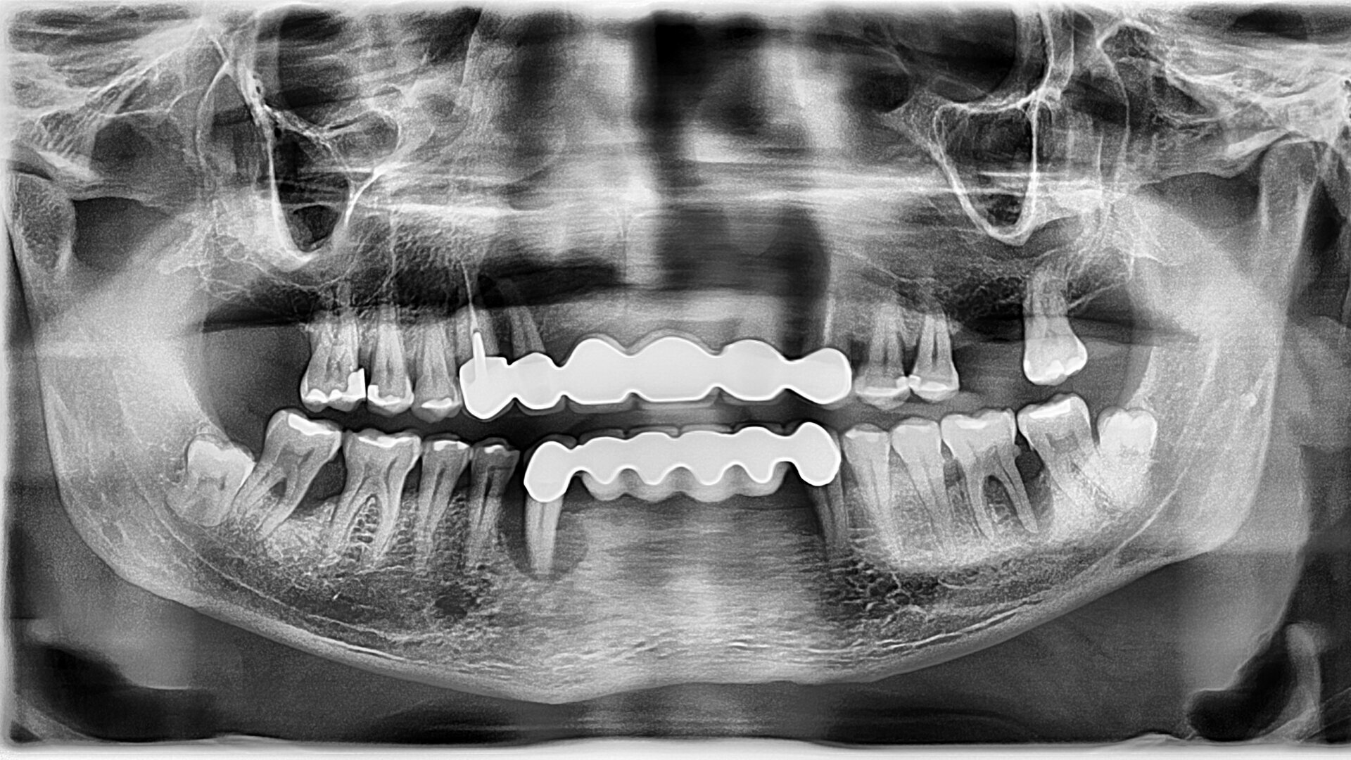 Treatment of patients with severe periodontal disease
