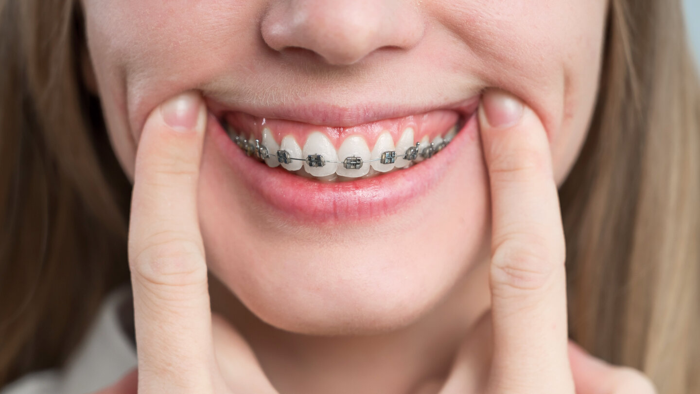 Dental News - Perio-ortho synergy: “Excellent periodontal health is ...
