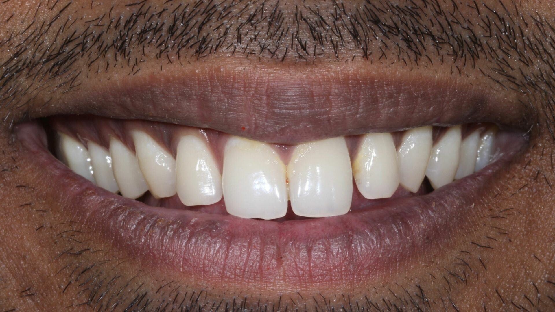 Smile makeover with composite veneers using injection moulding - Dr ...
