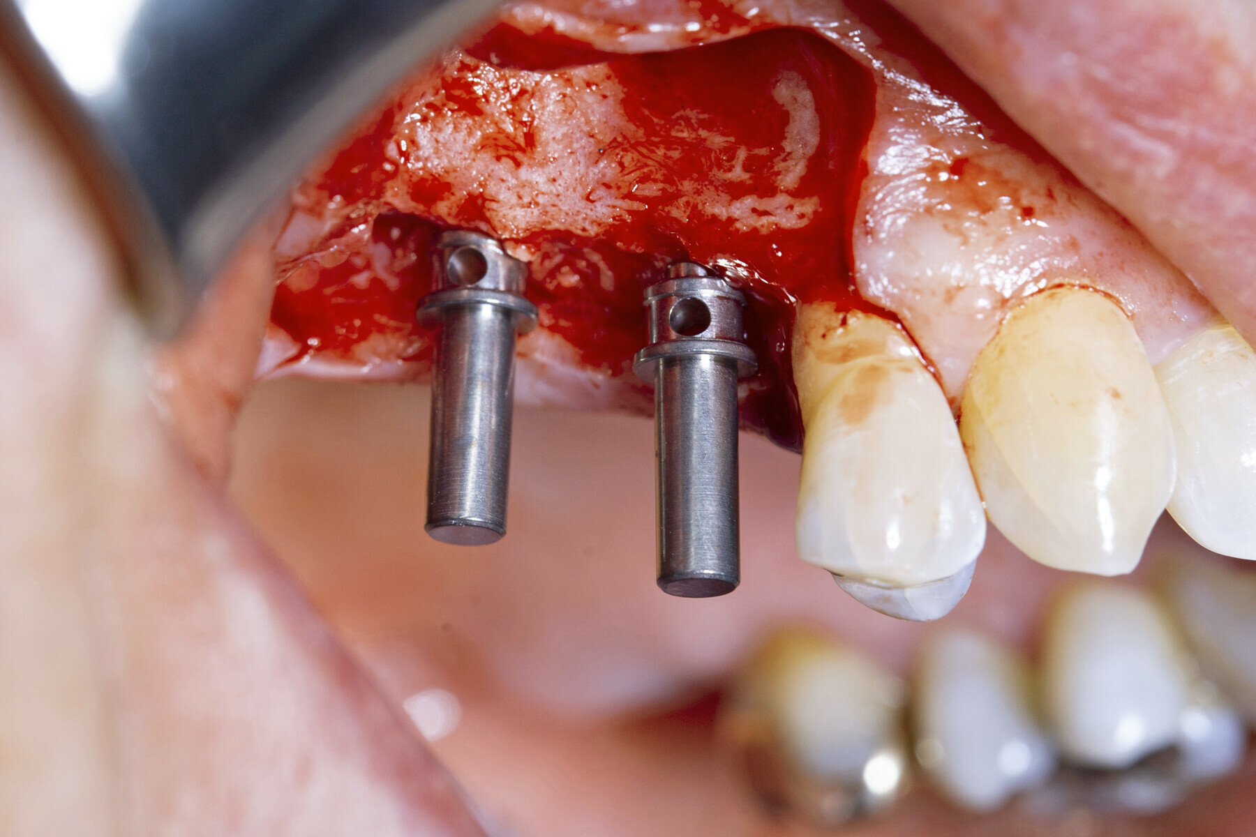 Screw-retained restoration