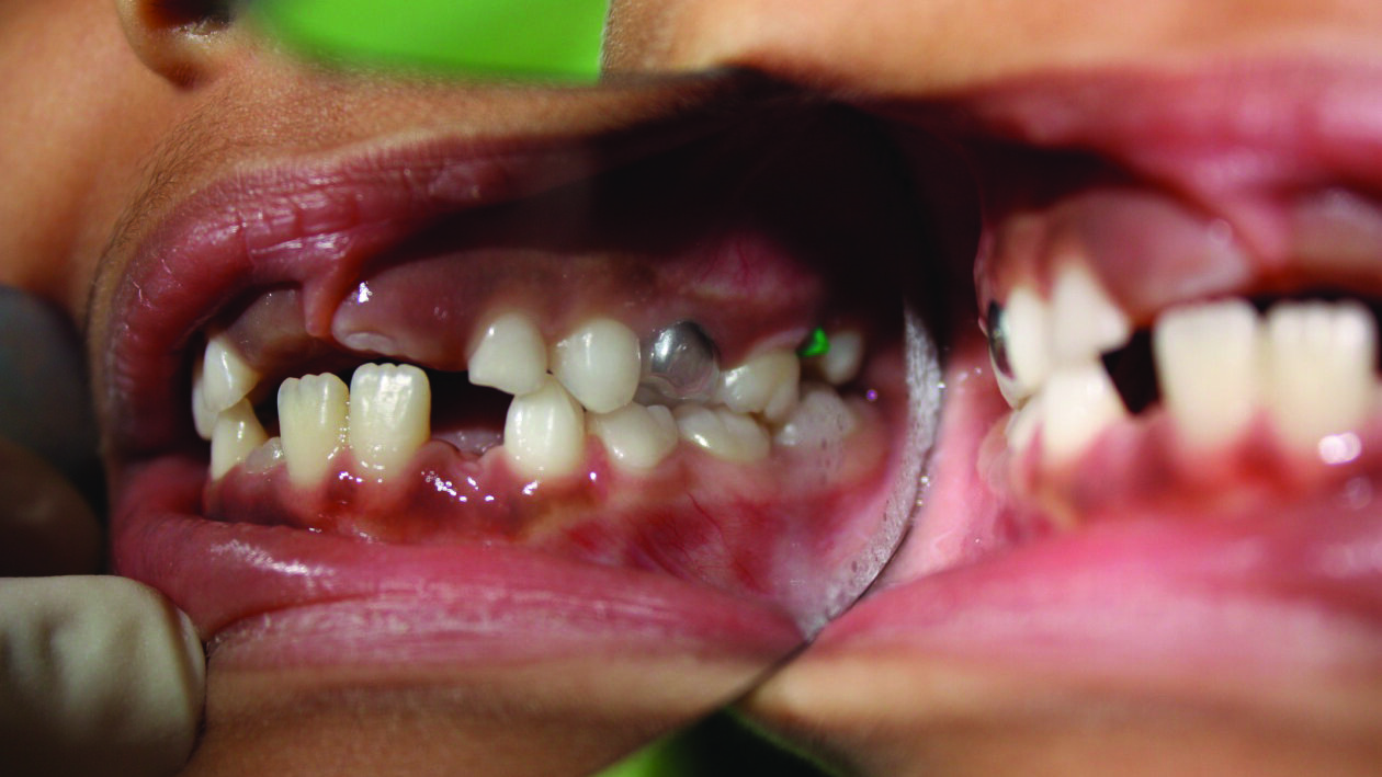 Management Of Ectopically Erupted First Permanent Molars