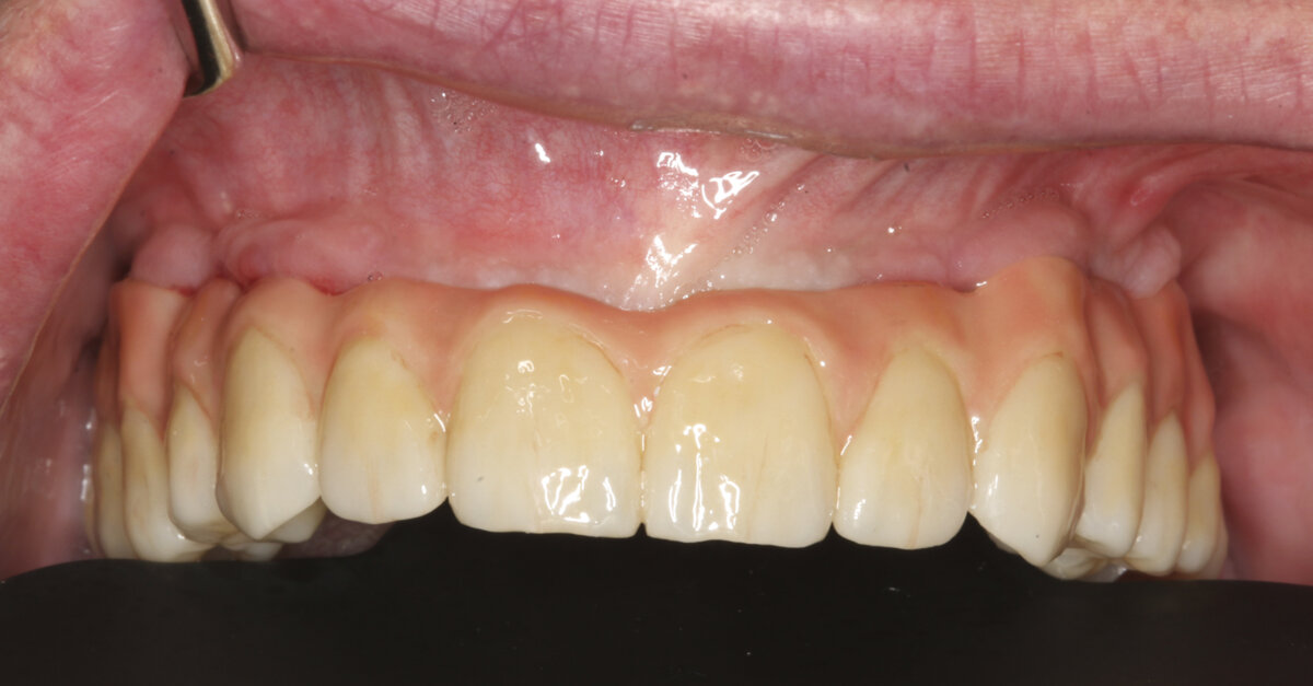 DT News - International - Immediate restoration of an edentulous maxilla