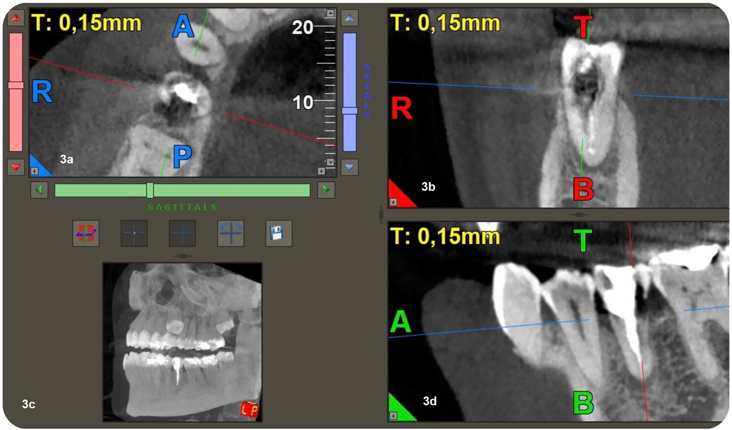 External cervical root resorption