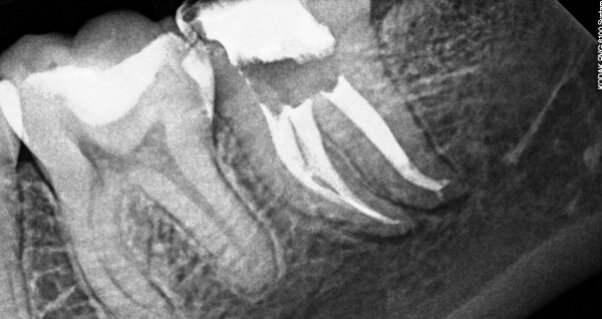 The ProTaper technique: Shaping the future of endodontics