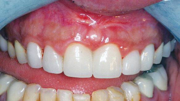 DT News - US - Unique maxillary frenectomy with a diode laser