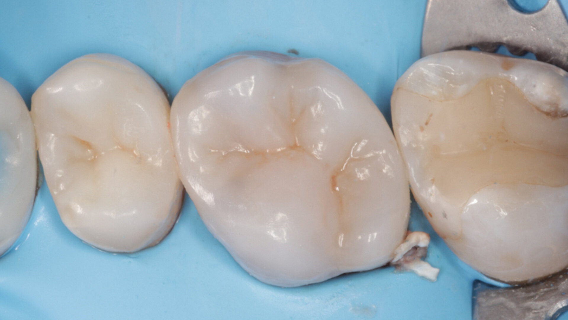 Dental News - Direct cuspal coverage with resin composite