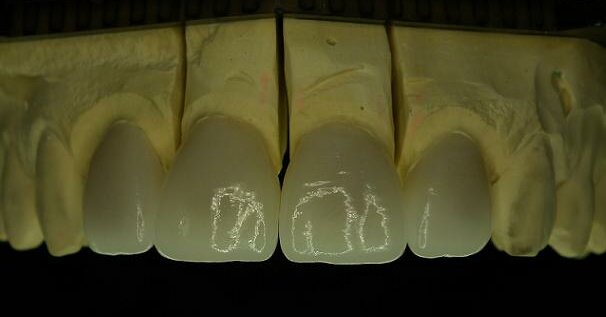 Dental News - Lithium disilicate—An effective solution for ...