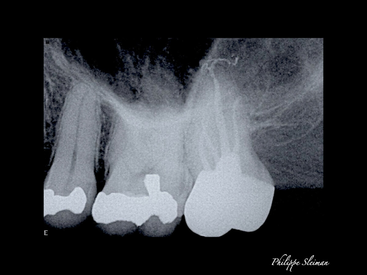 Clinical management of maxillary second molar root canal therapy in ...