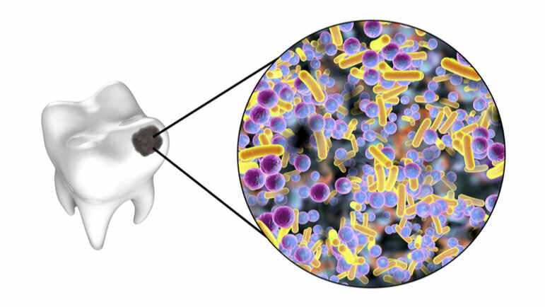 Dental News - Researchers sequence rare bacterium that causes rampant ...