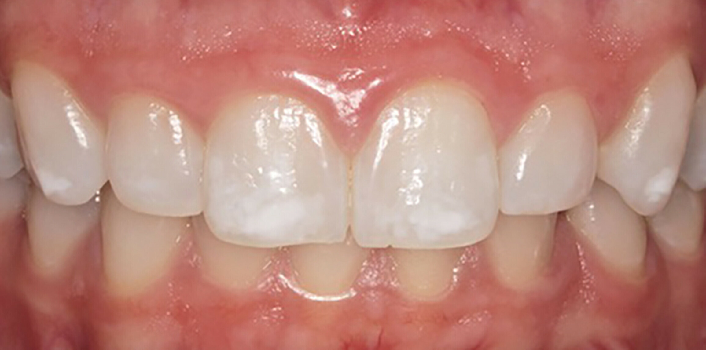 Dental News - Conservative aesthetic management of white spot fluorosis ...