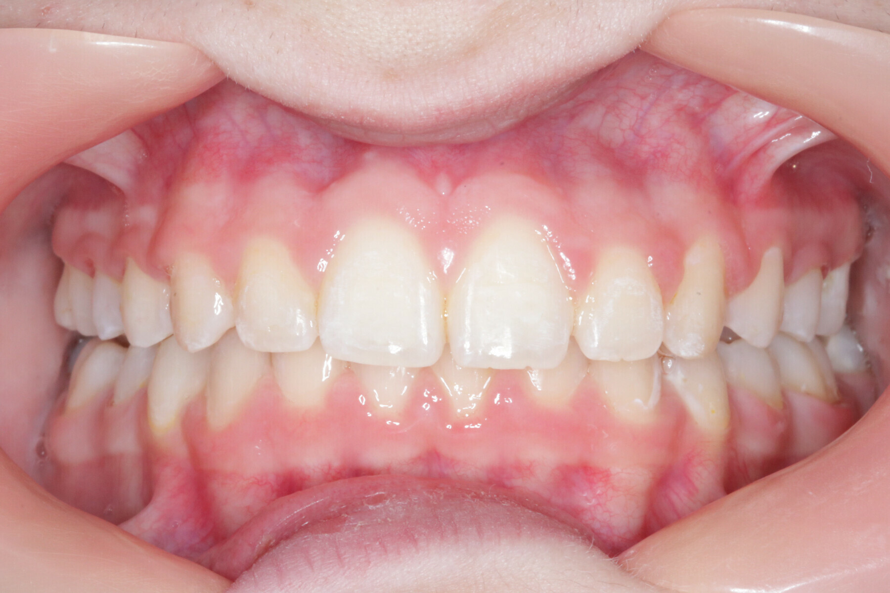 Dental News - Boosting facial aesthetics through a hybrid approach of ...