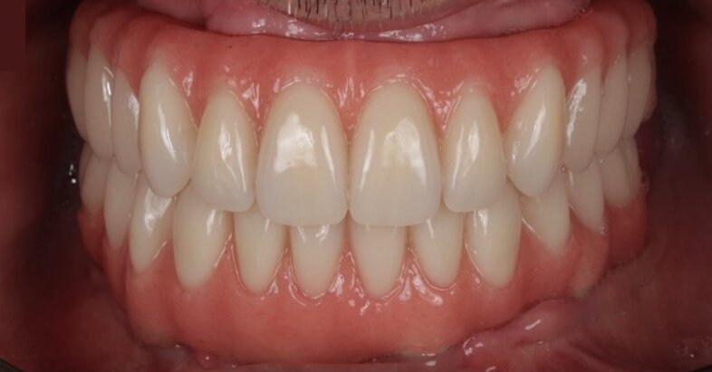 PEEK implant-supported prostheses to be discussed in webinar