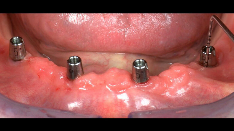 DT News - International - Implant-supported mandibular complete ...
