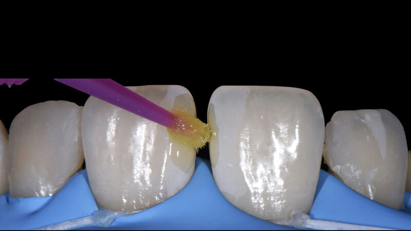 Diastema closure using a direct two-matrix technique