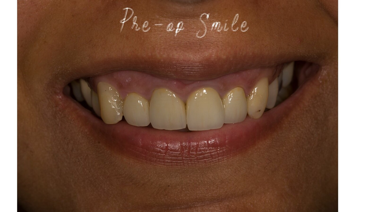 Saving Seemingly Hopeless Teeth In Aesthetic Zone: Team Approach : Dr ...