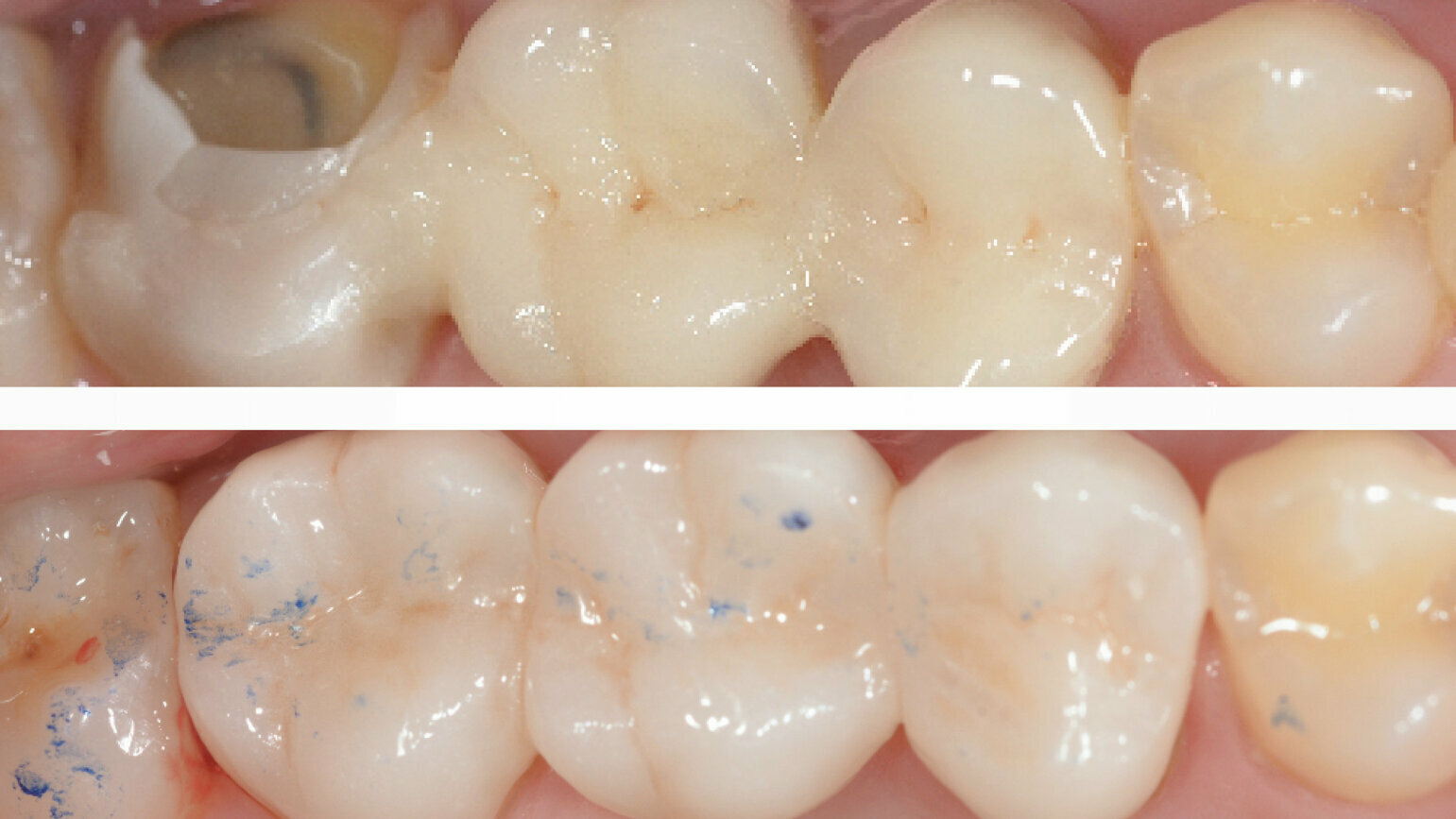 A three-unit bridge restoration of a fractured ceramic crown