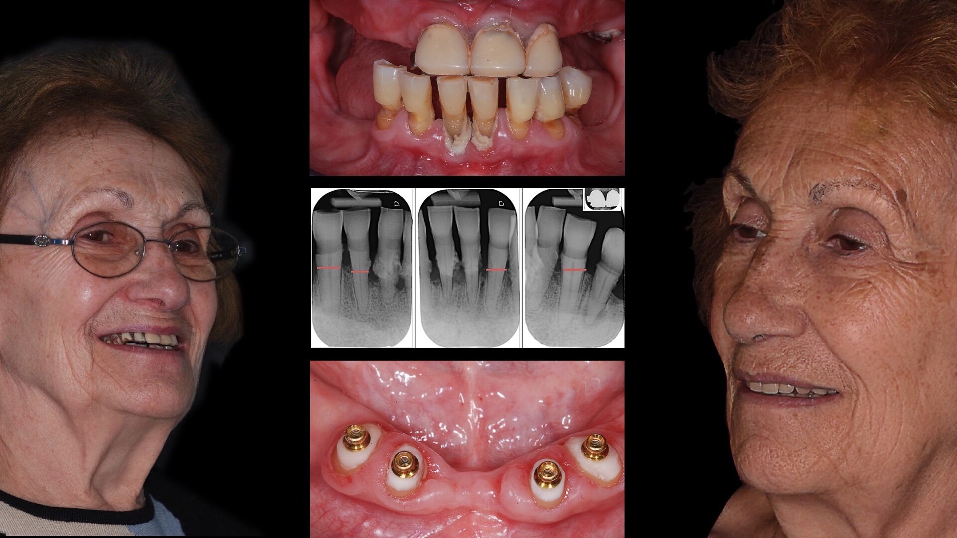 DT News - Latin America - Colocación de sobredentadura sobre raíz ...